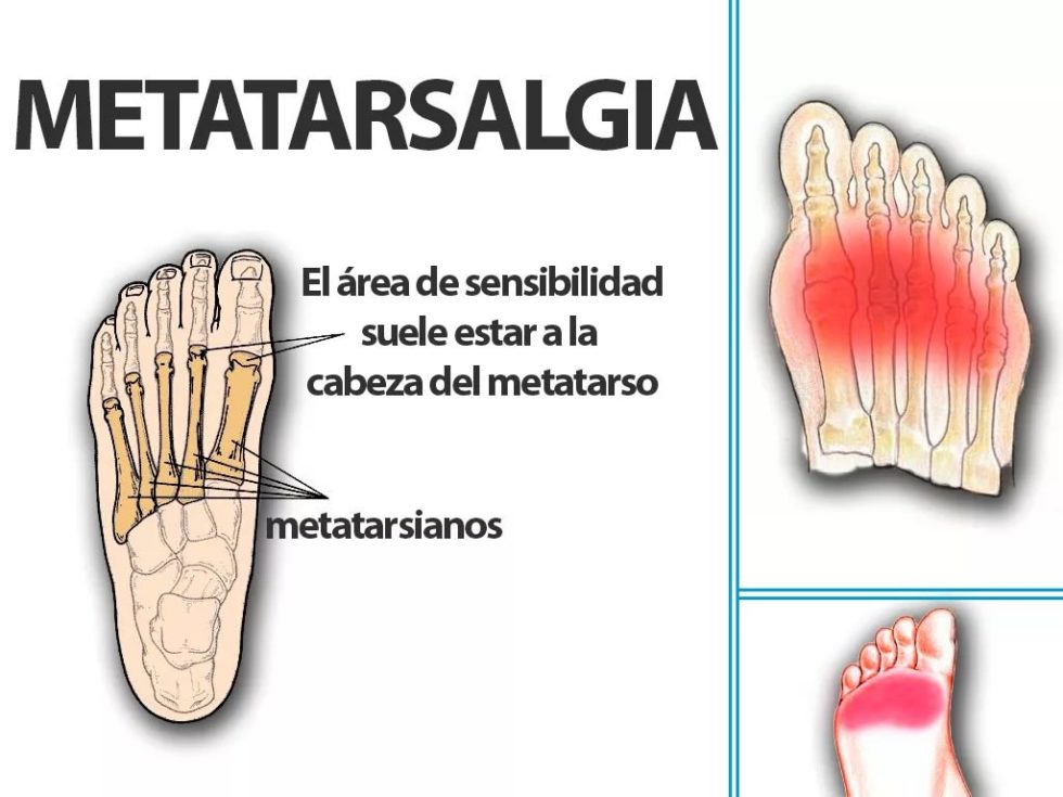 Tratamiento Metatarsalgias - Isomedic